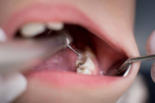 How Long Do Composite Fillings Last Rapid City Sd